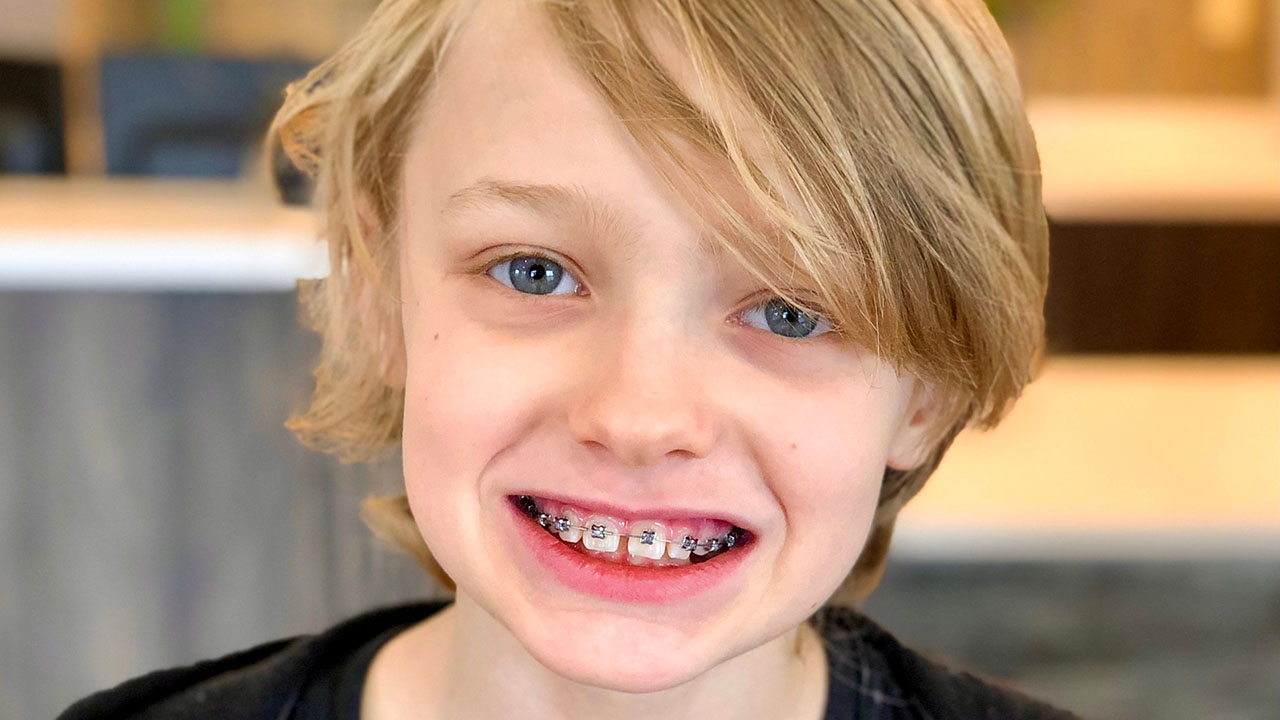 What Is Phase 1 Orthodontics? | Fort Wayne IN Orthodontists